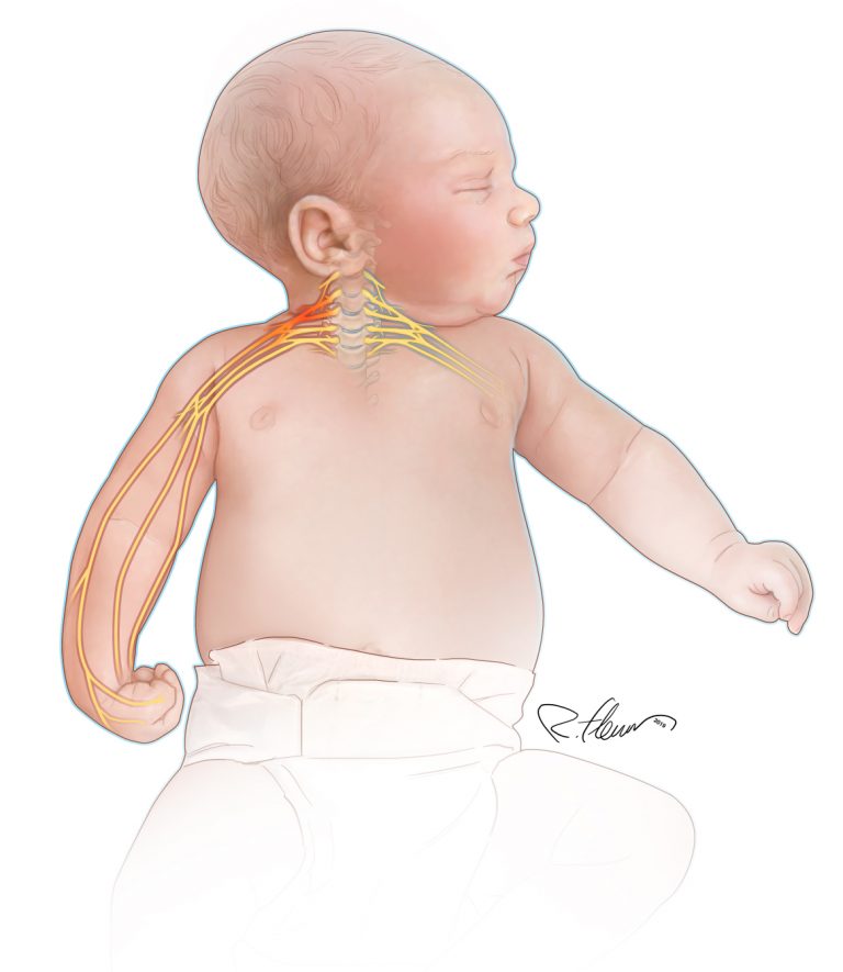 Shoulder Dystocia/Erb’s Palsy/Brachial Plexus Injury